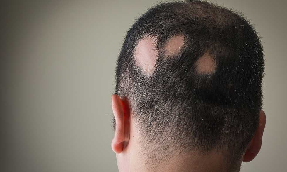 pérdida del cabello, pérdida anormal de pelo que se trata conforme la ...